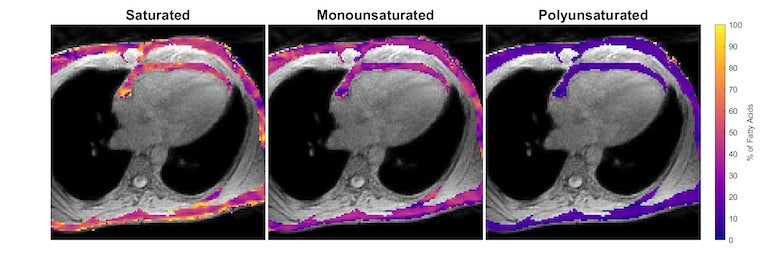 New MRI Technique Assesses Composition of Adipose Fat Surrounding the ...