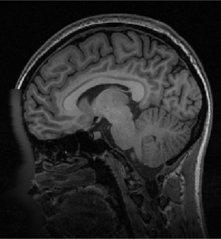 AI Models Seek to Make Brain MRI More Accurate and Reliable | Applied ...