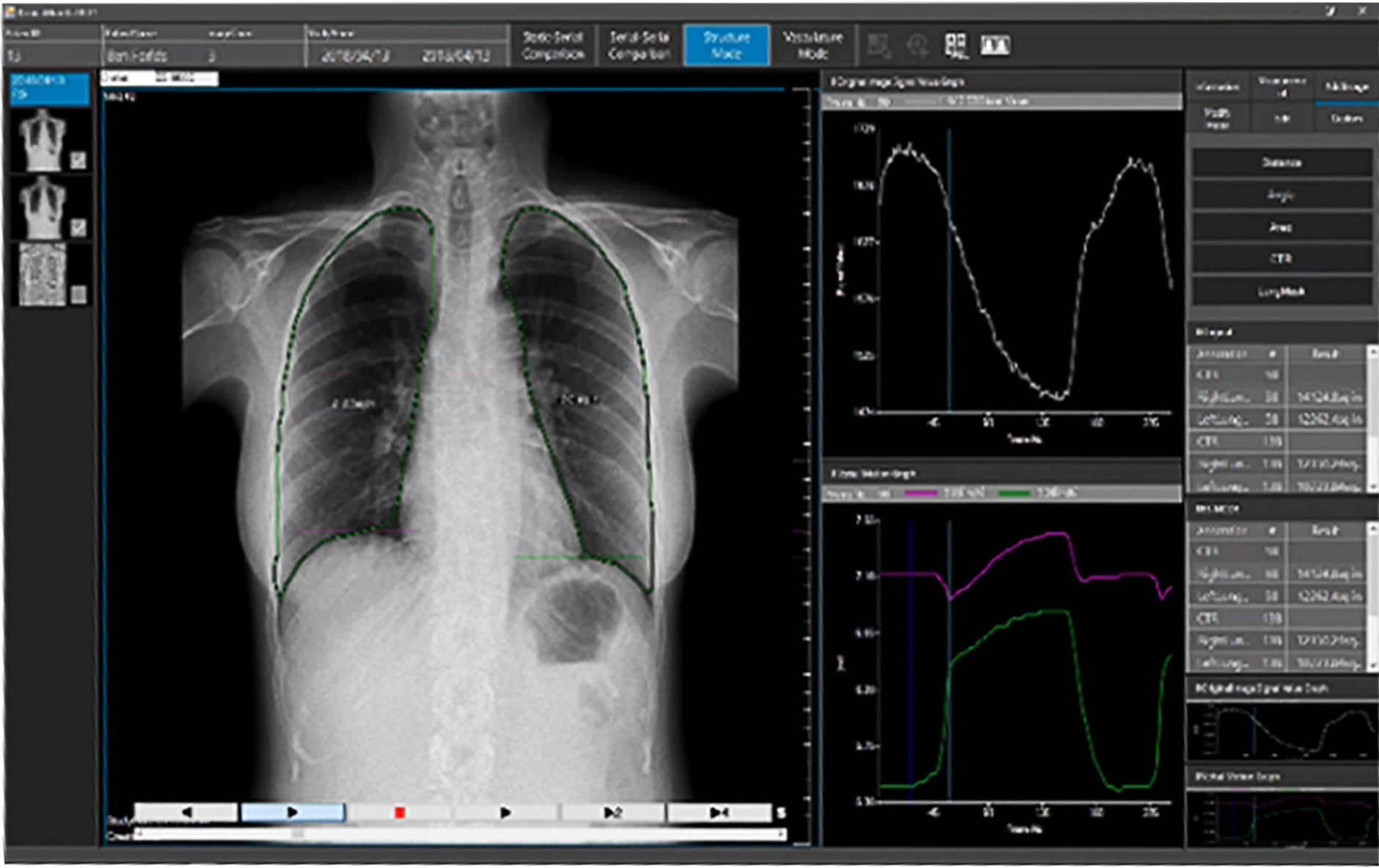 Study Reports Dynamic Digital Radiography Quantitatively Diagnoses ...