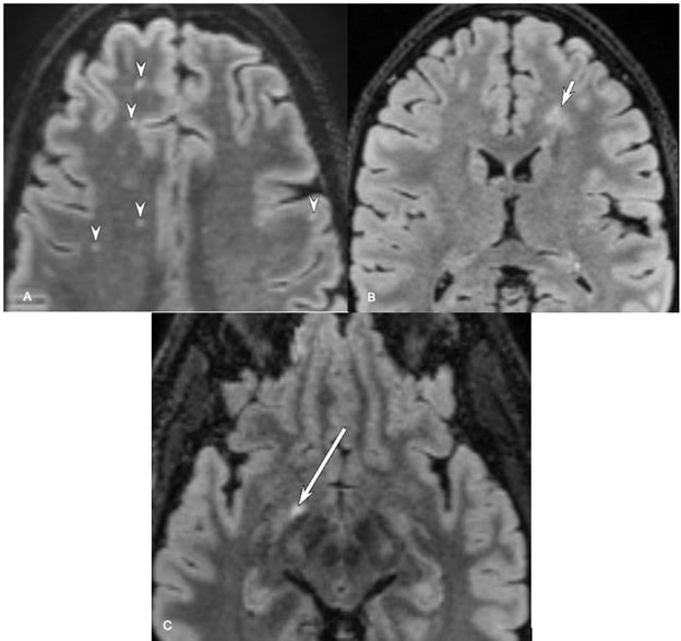 White Matter Hyperintensities in Brain Are Not Biomarkers for mTBI on ...