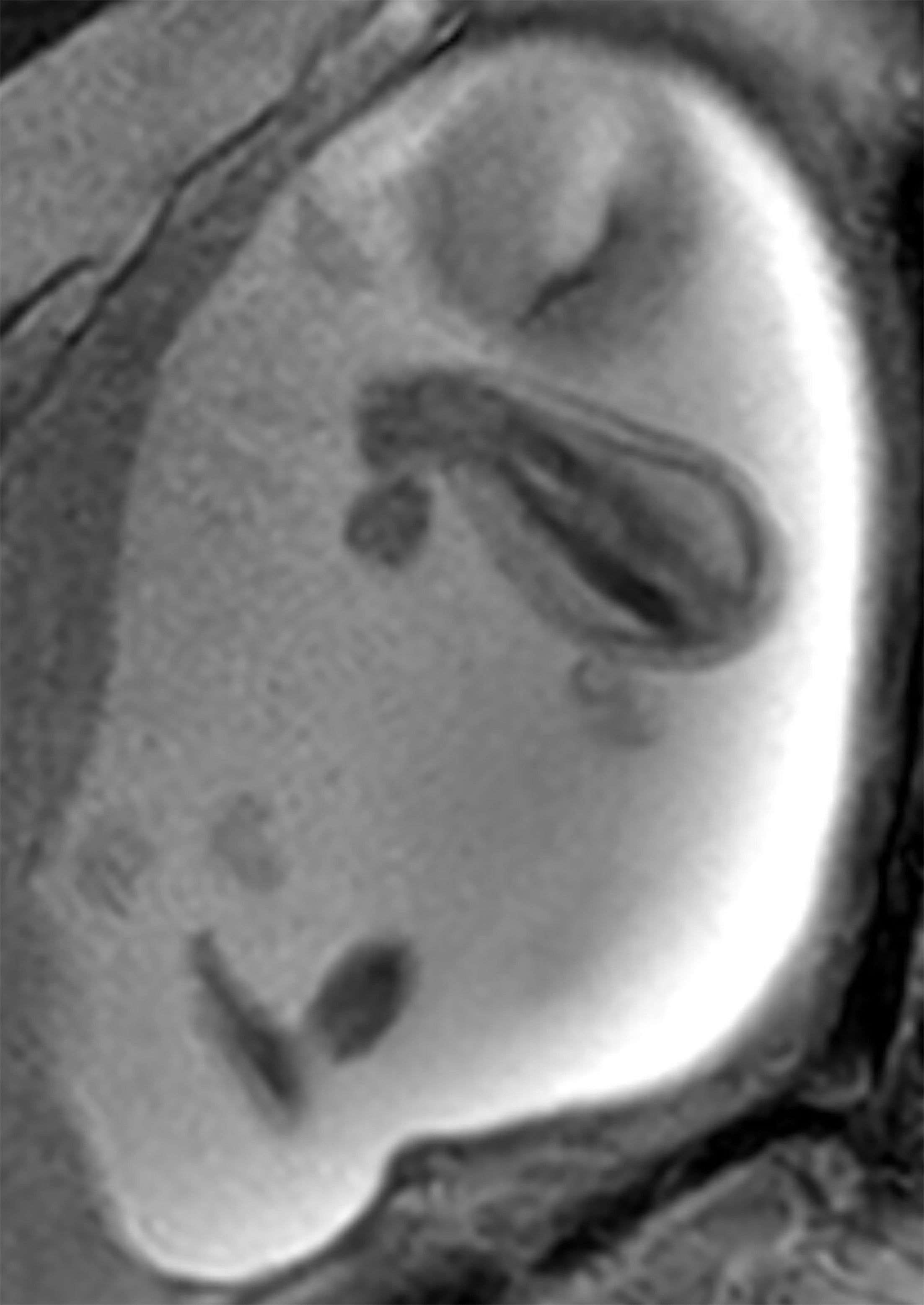 Misdiagnosed High-Grade Undifferentiated Sarcoma Mimicking Infantile ...