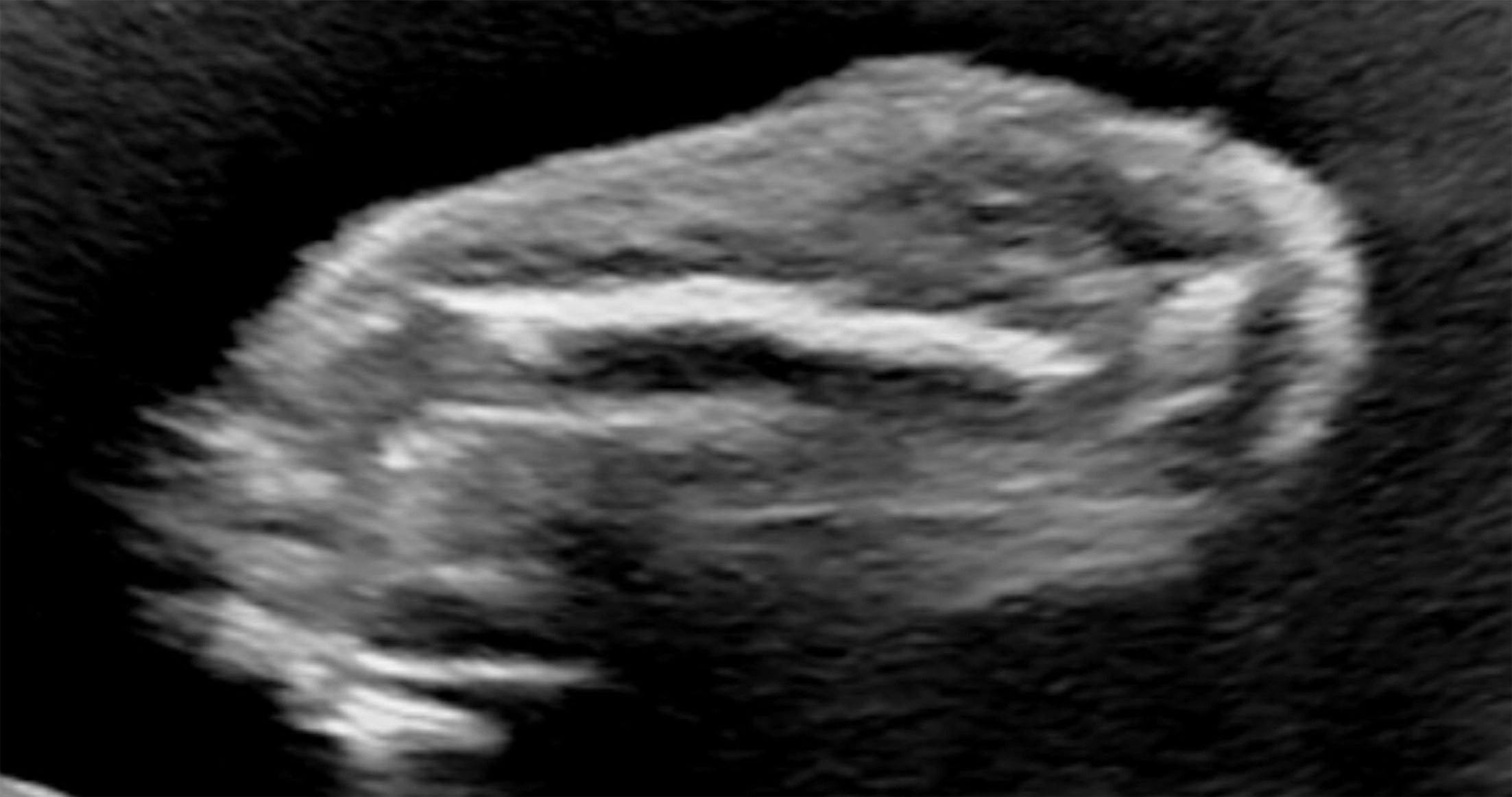 Misdiagnosed High-Grade Undifferentiated Sarcoma Mimicking Infantile ...