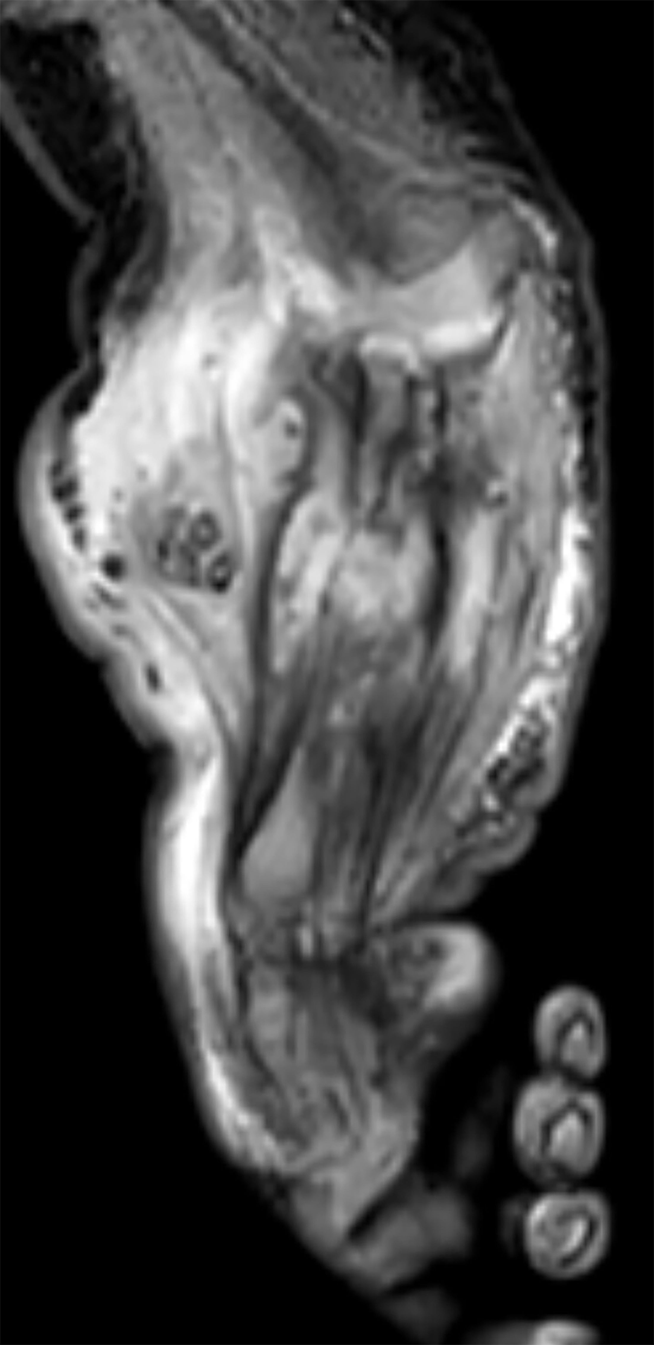 Misdiagnosed High-Grade Undifferentiated Sarcoma Mimicking Infantile ...