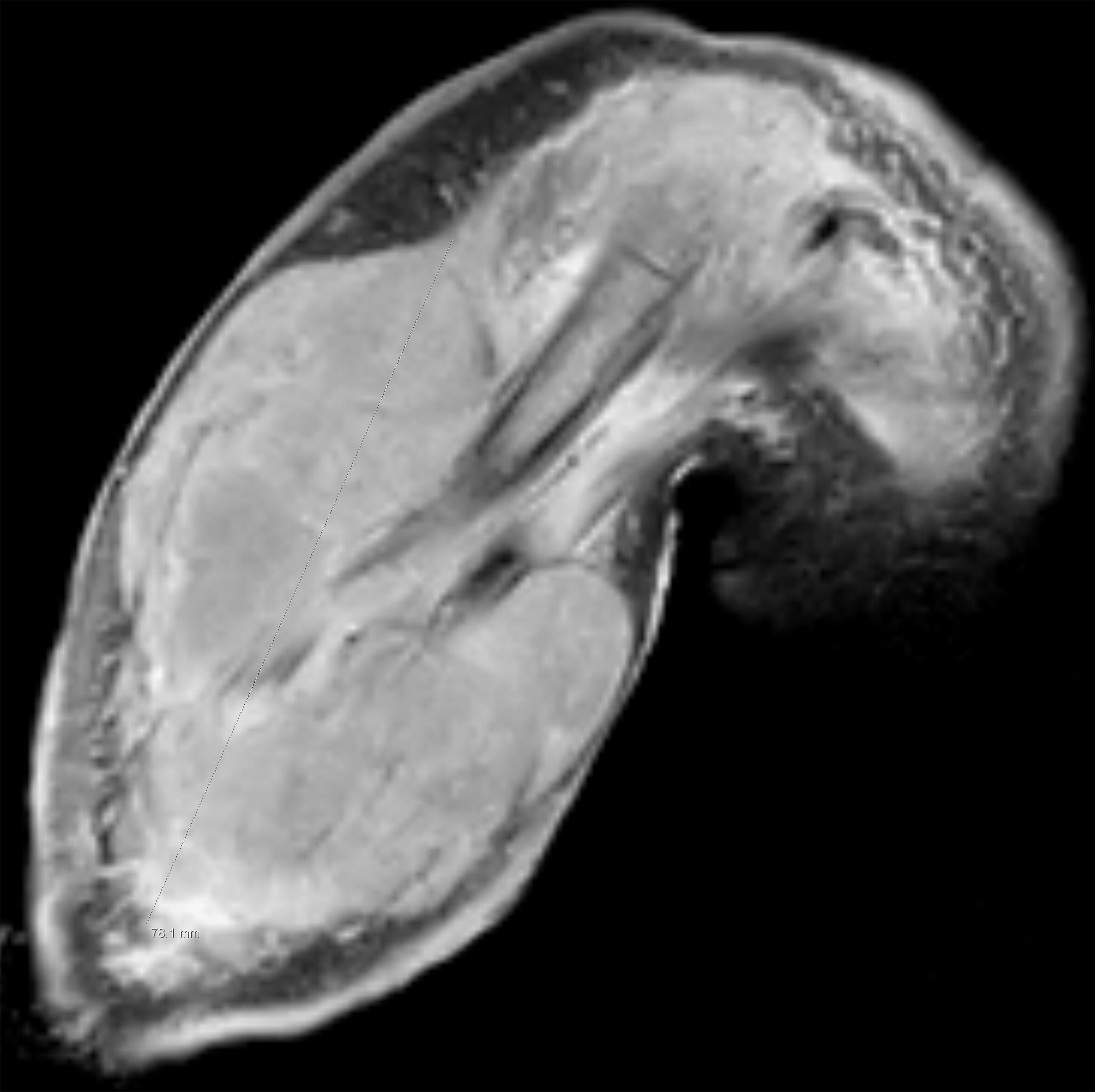 Misdiagnosed High-Grade Undifferentiated Sarcoma Mimicking Infantile ...