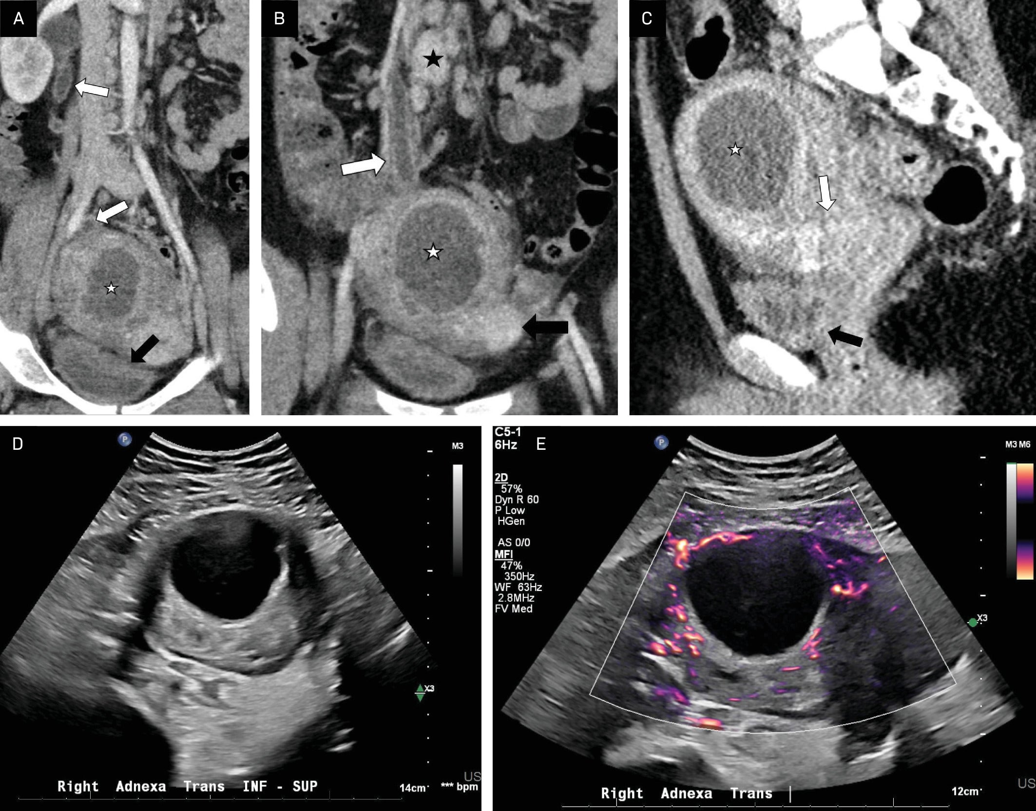Tubo-Ovarian Abscess | Applied Radiology