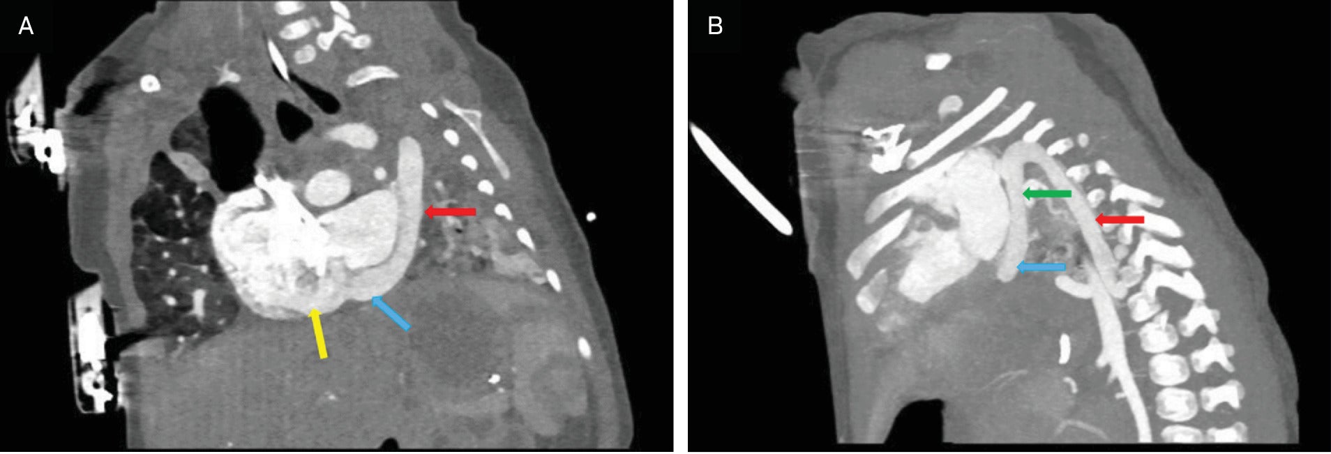 Variant of Left-Sided Scimitar Syndrome | Applied Radiology