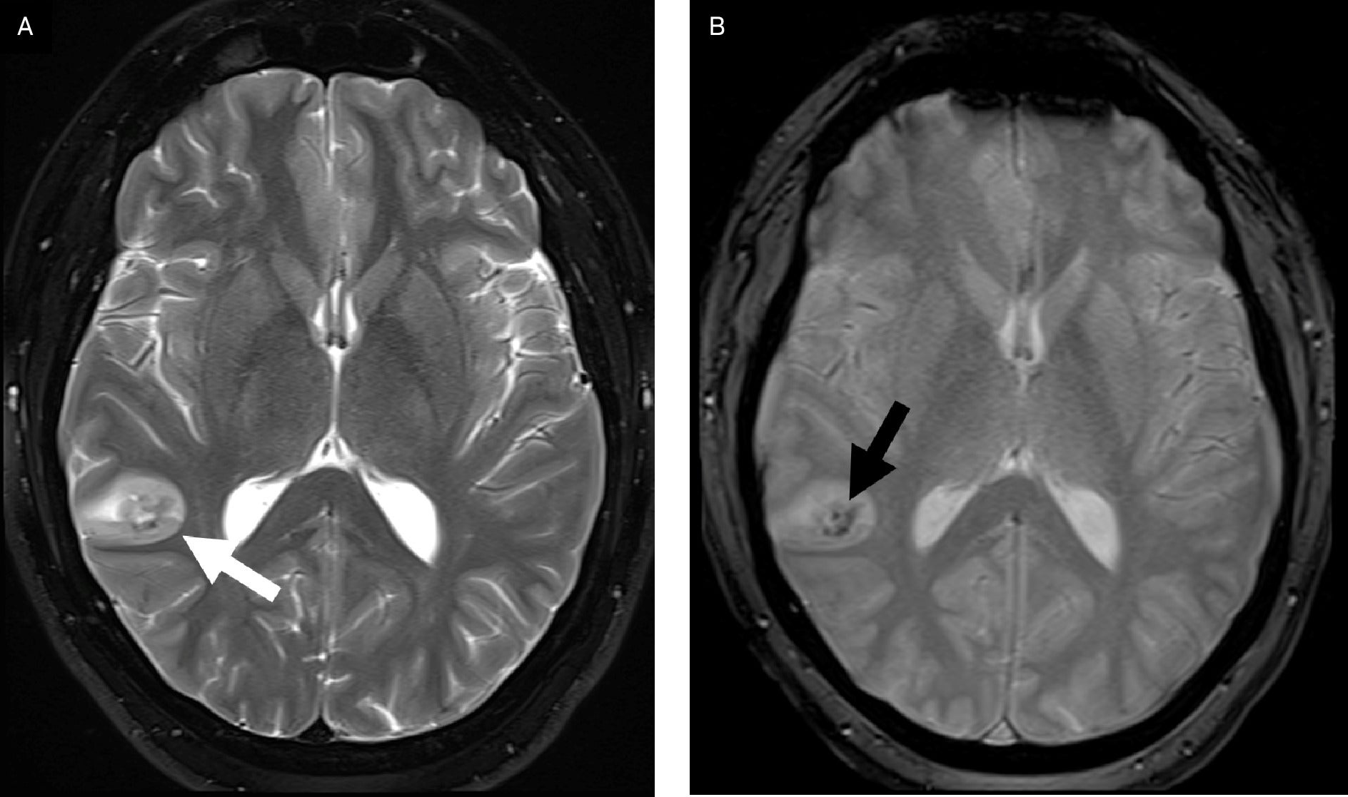 Glioneuronal Tumors: A Pictorial Review and Practical Approach ...