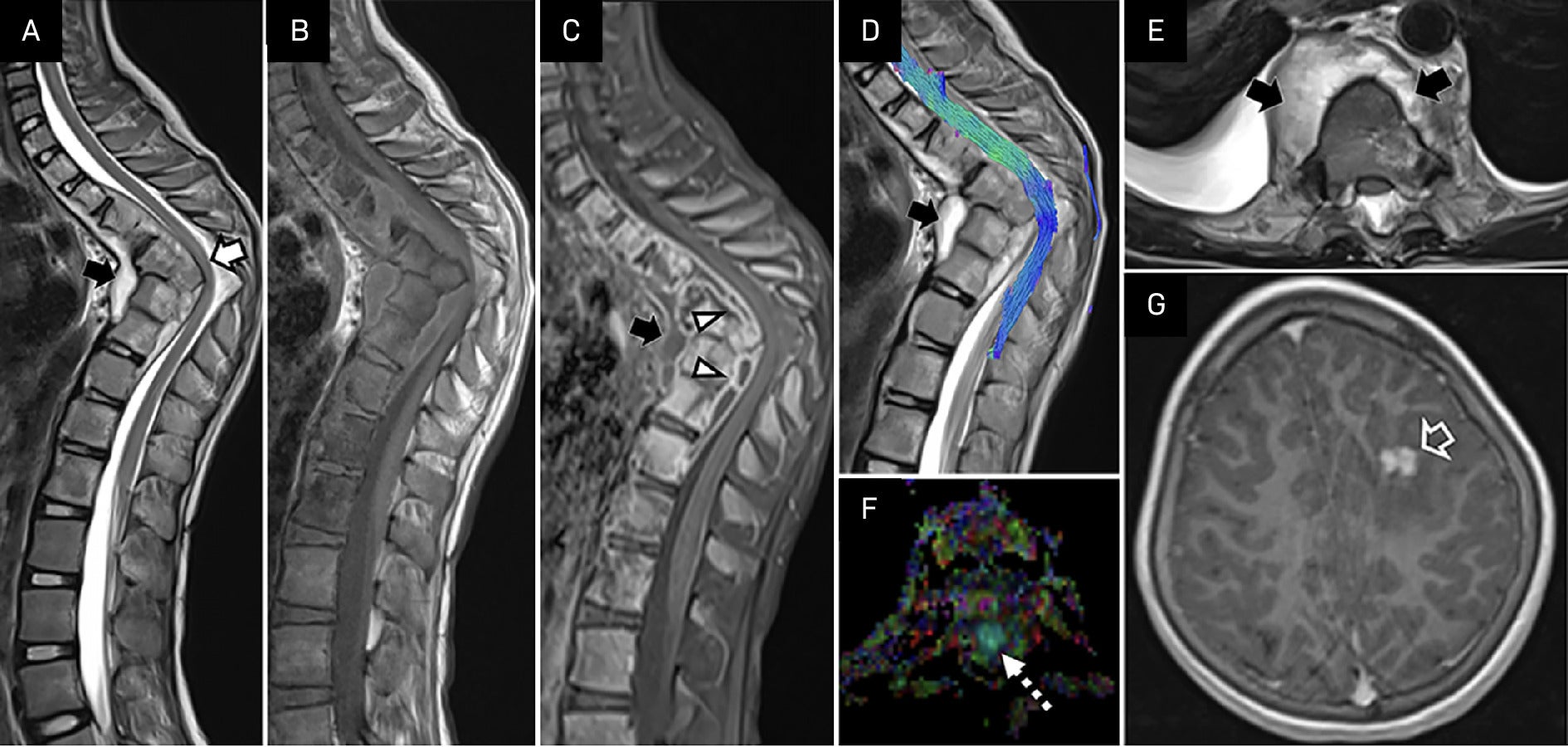 From Signals to Signs: Diffusion Tensor Imaging and Fiber Tractography ...