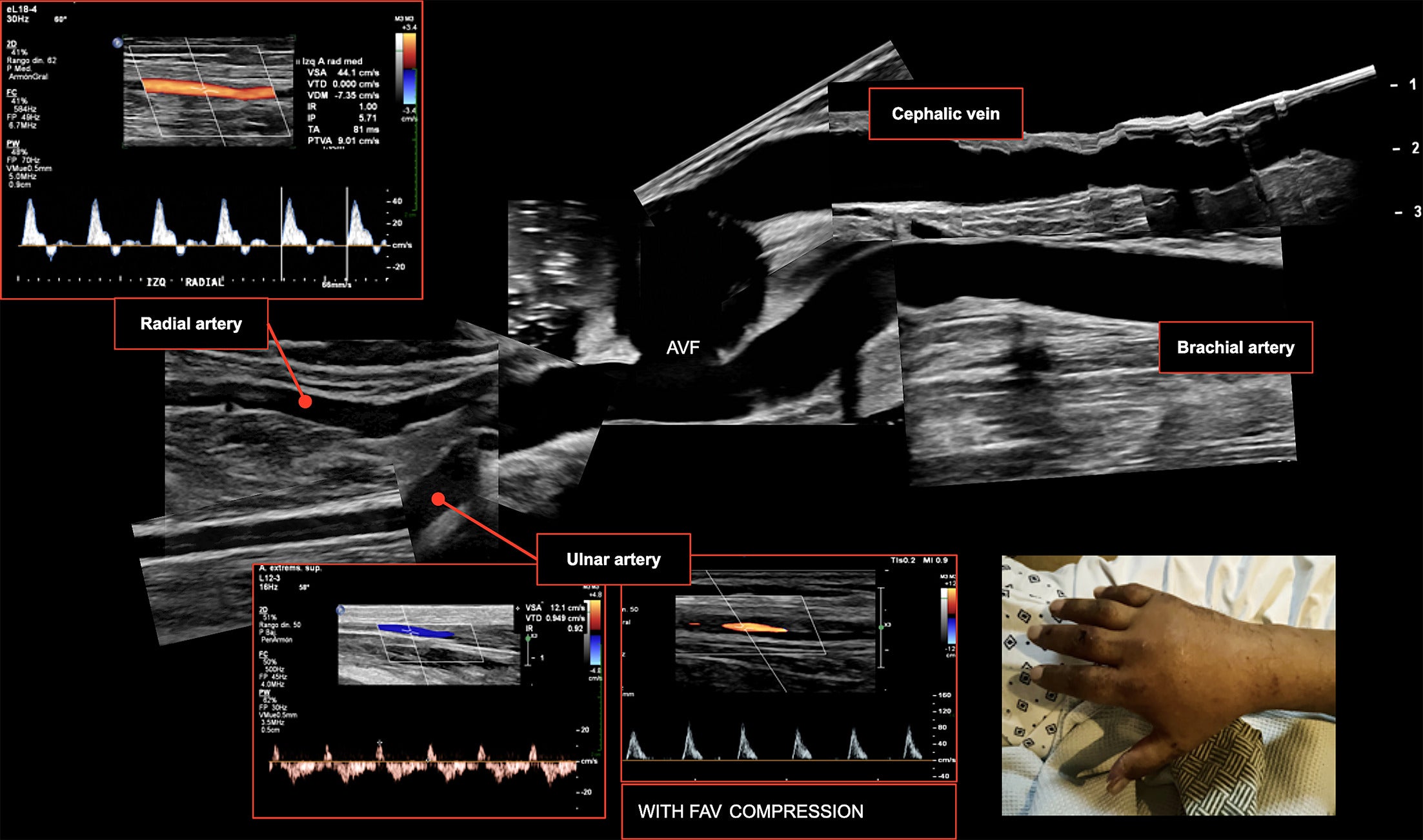 US Evaluation of Arteriovenous Fistula Complications in the Emergency ...