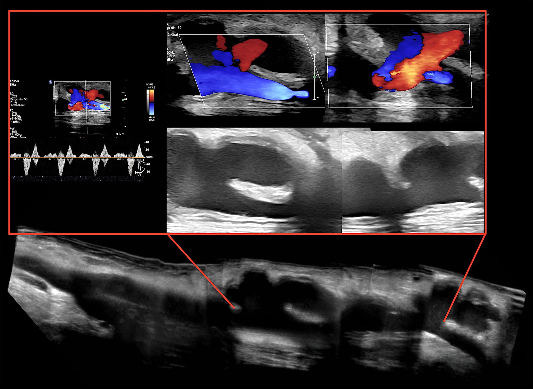 US Evaluation of Arteriovenous Fistula Complications in the Emergency ...