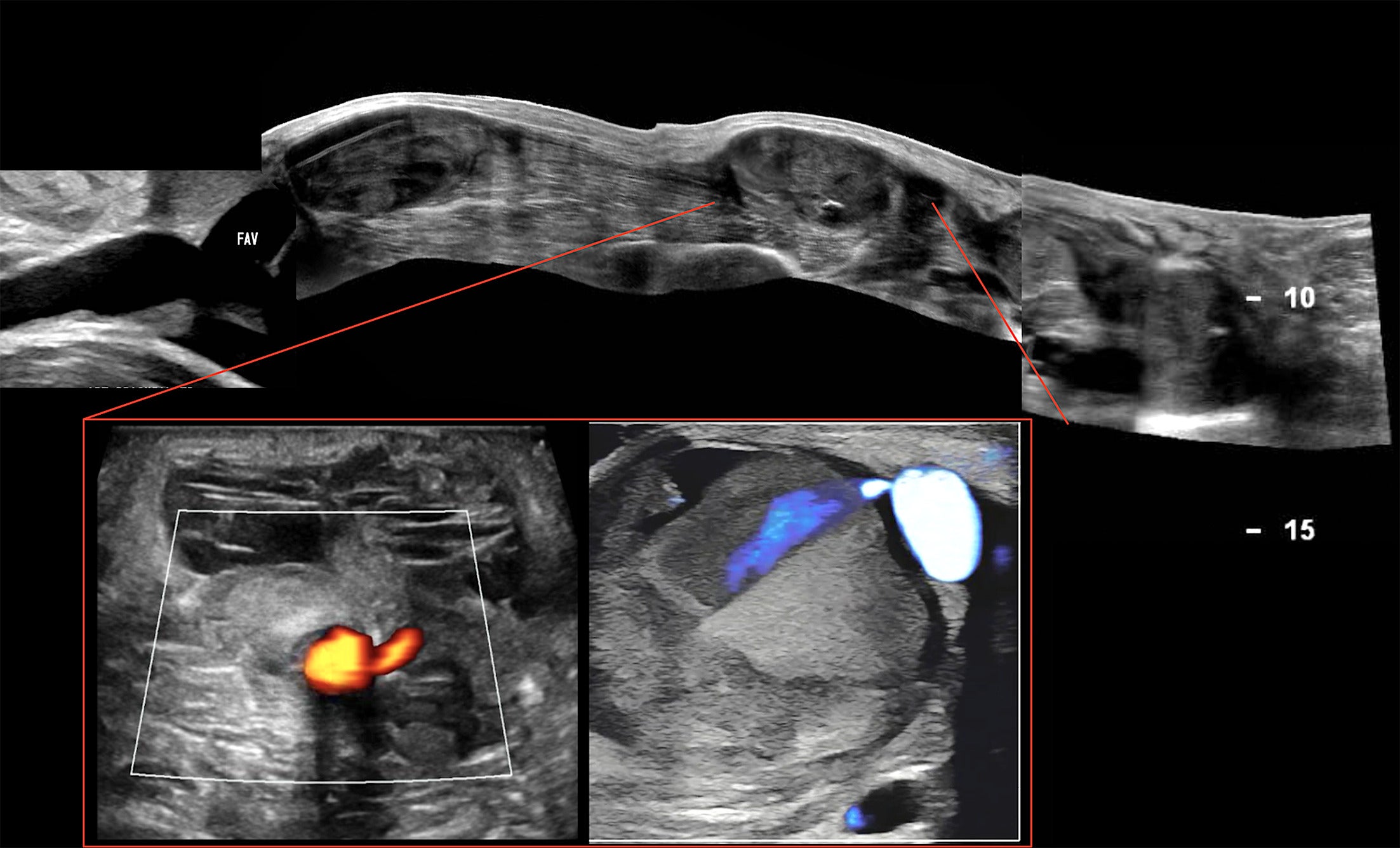 US Evaluation of Arteriovenous Fistula Complications in the Emergency ...