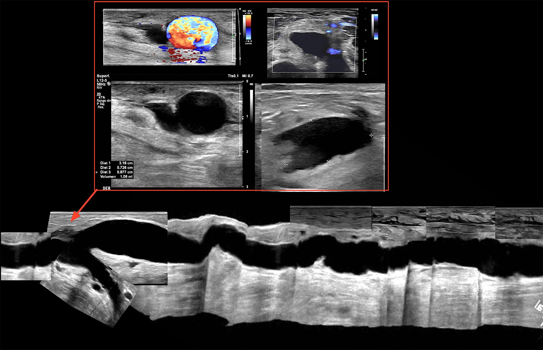US Evaluation of Arteriovenous Fistula Complications in the Emergency ...