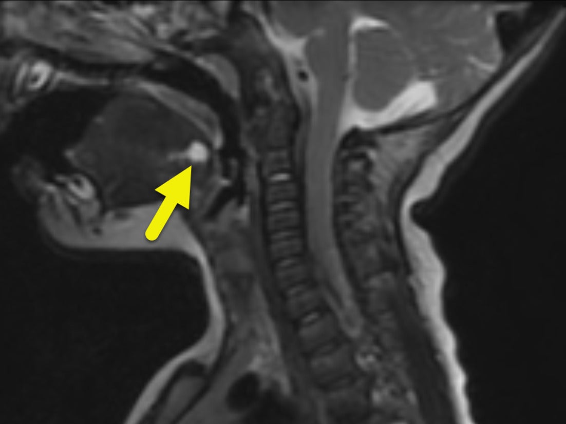 Thyroglossal Duct Cyst | Applied Radiology