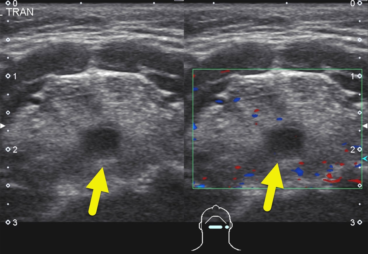 Thyroglossal Duct Cyst | Applied Radiology