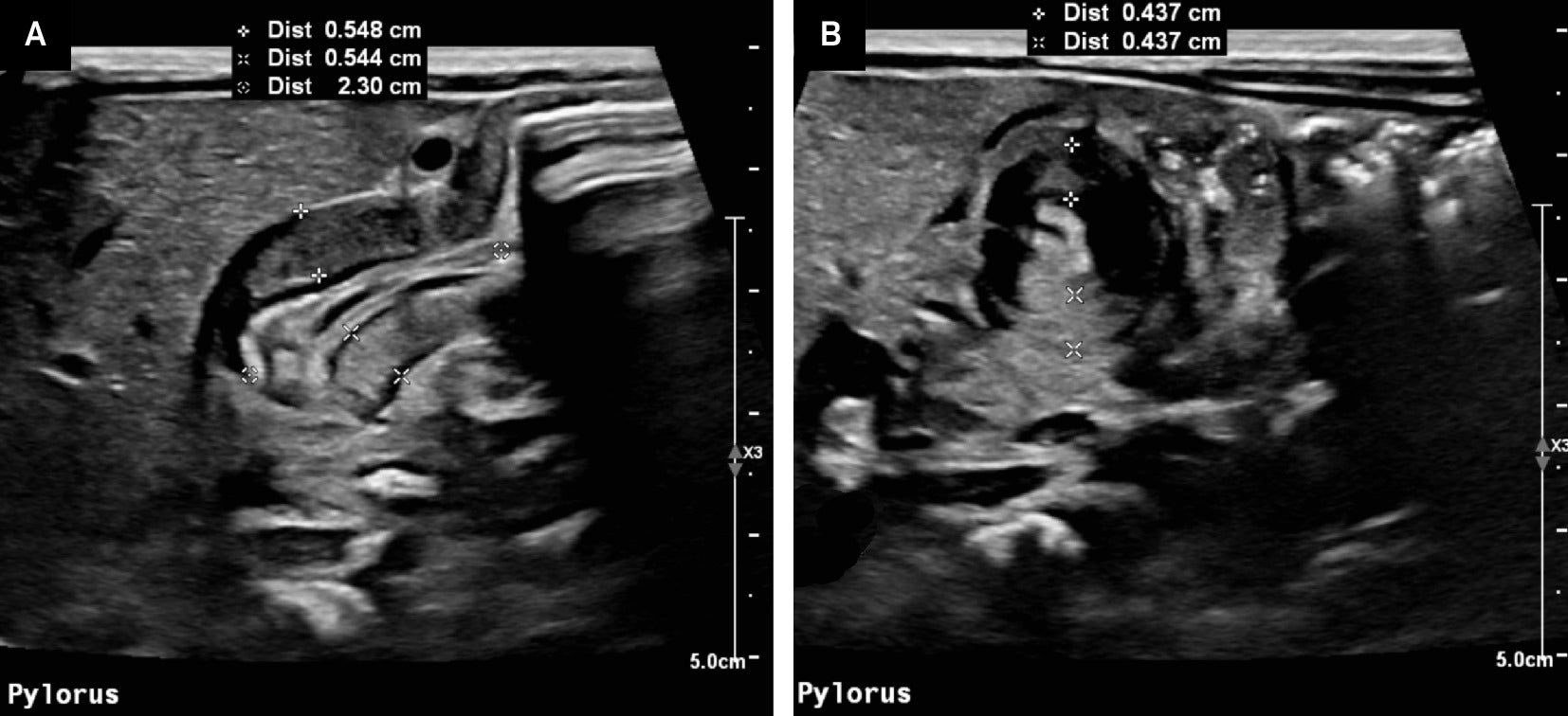 Hypertrophic Pyloric Stenosis | Applied Radiology