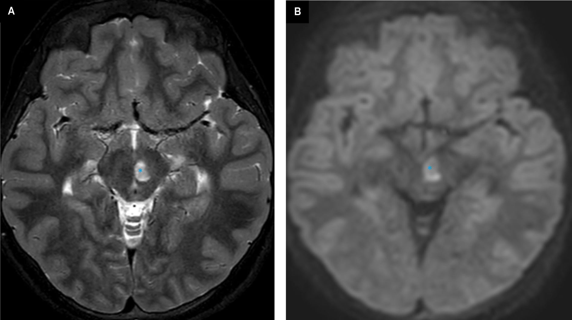 Leigh Syndrome | Applied Radiology