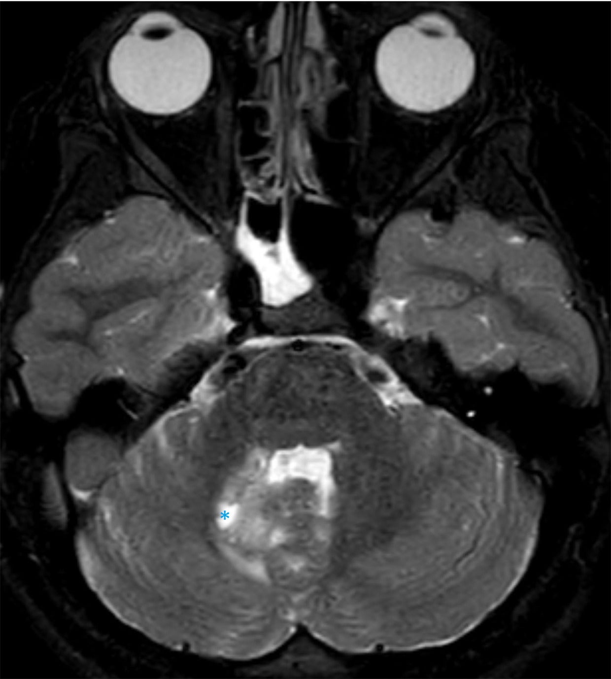 Leigh Syndrome | Applied Radiology