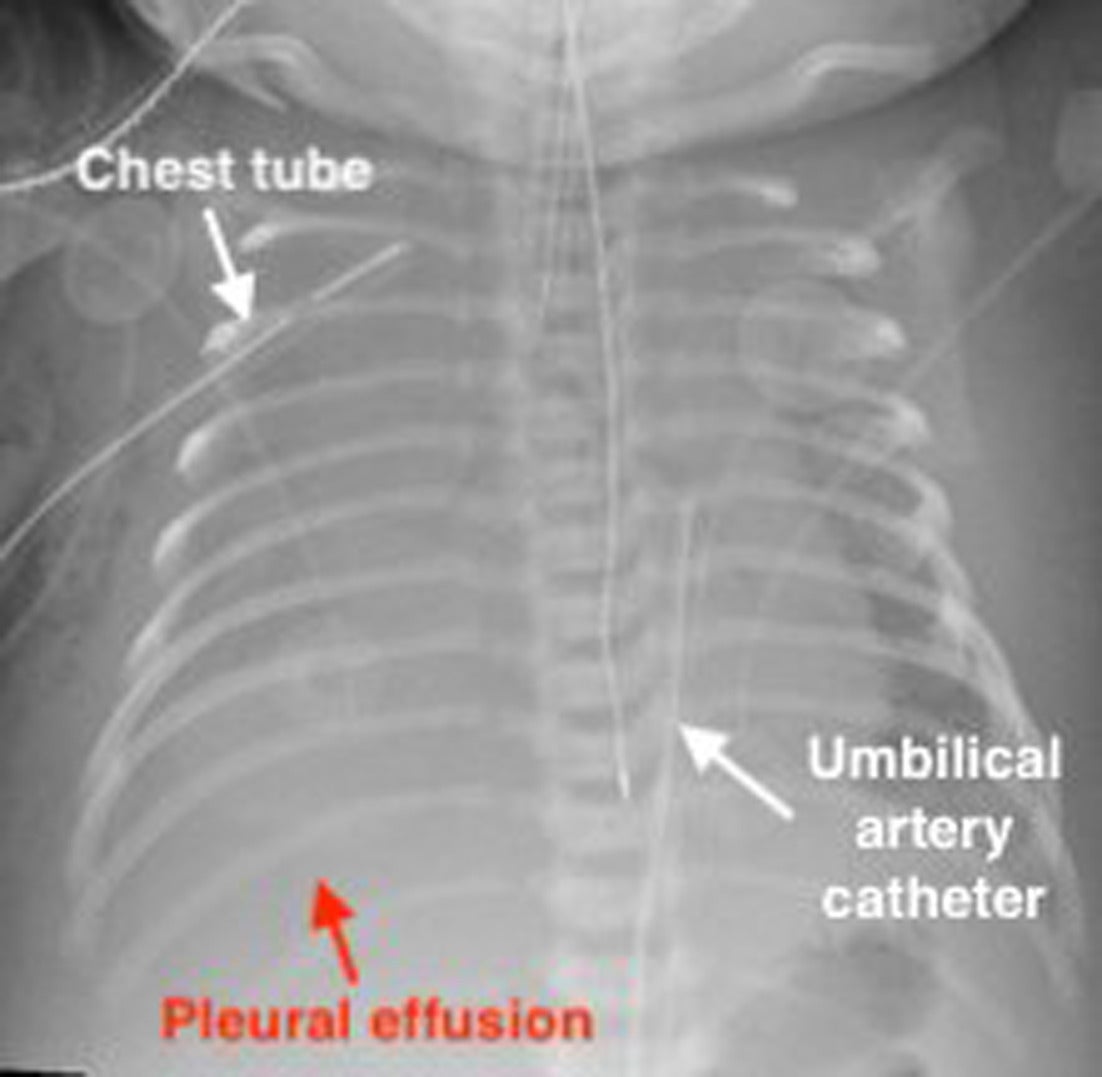 Congenital Chylothorax | Applied Radiology