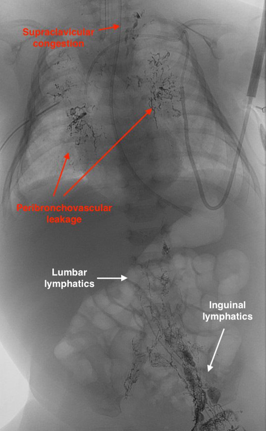 Congenital Chylothorax | Applied Radiology
