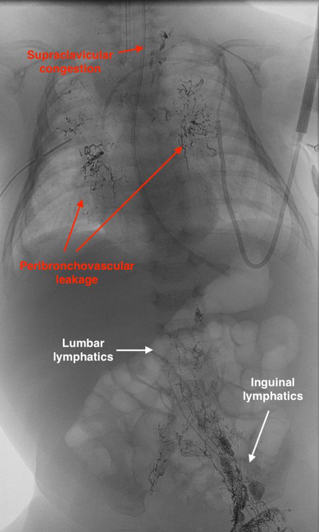 Congenital Chylothorax | Applied Radiology
