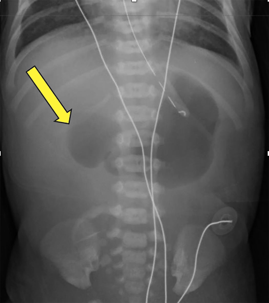Duodenal Atresia | Applied Radiology