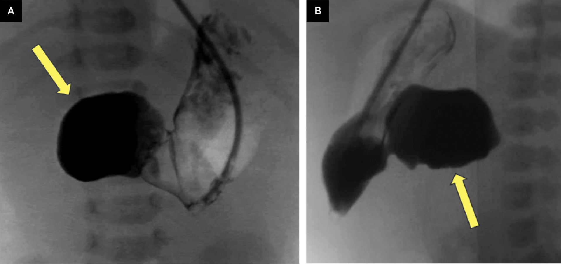Duodenal Atresia | Applied Radiology