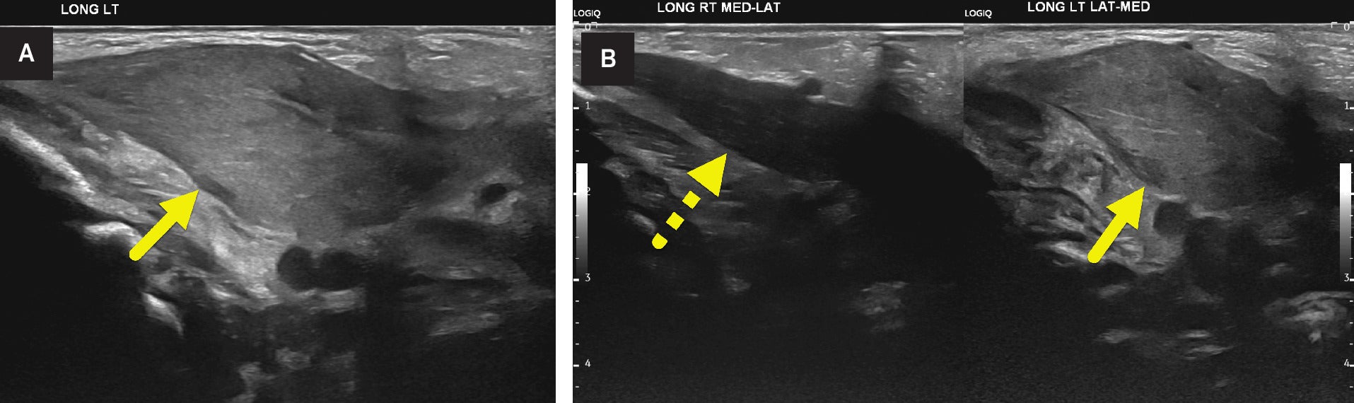 Torticollis in Neonates | Applied Radiology