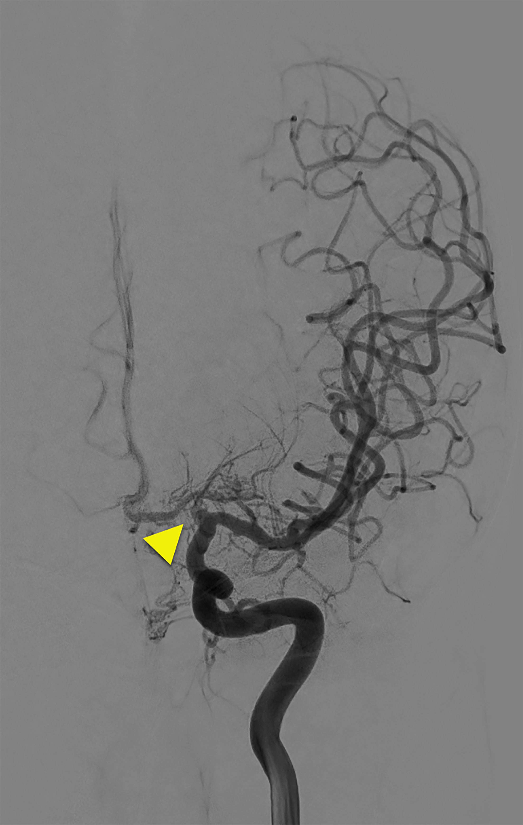 Moyamoya Disease | Applied Radiology
