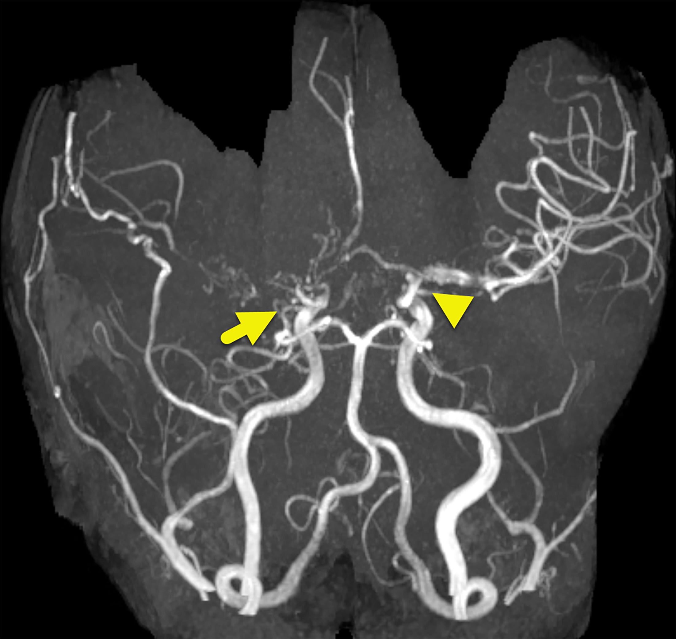 Moyamoya Disease | Applied Radiology