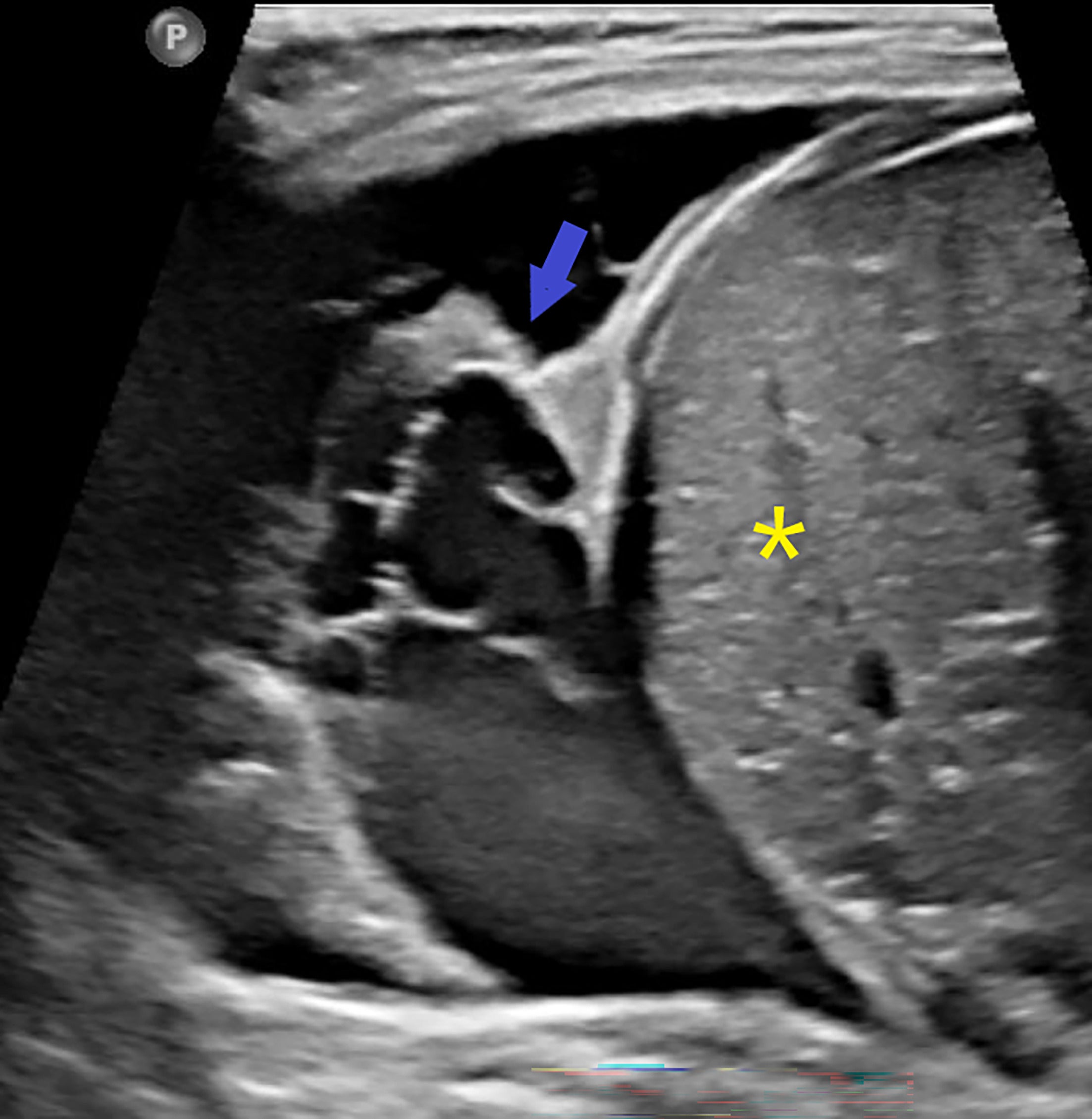 Pleural Effusion and the Approach to Therapy: Simple Versus Complex ...