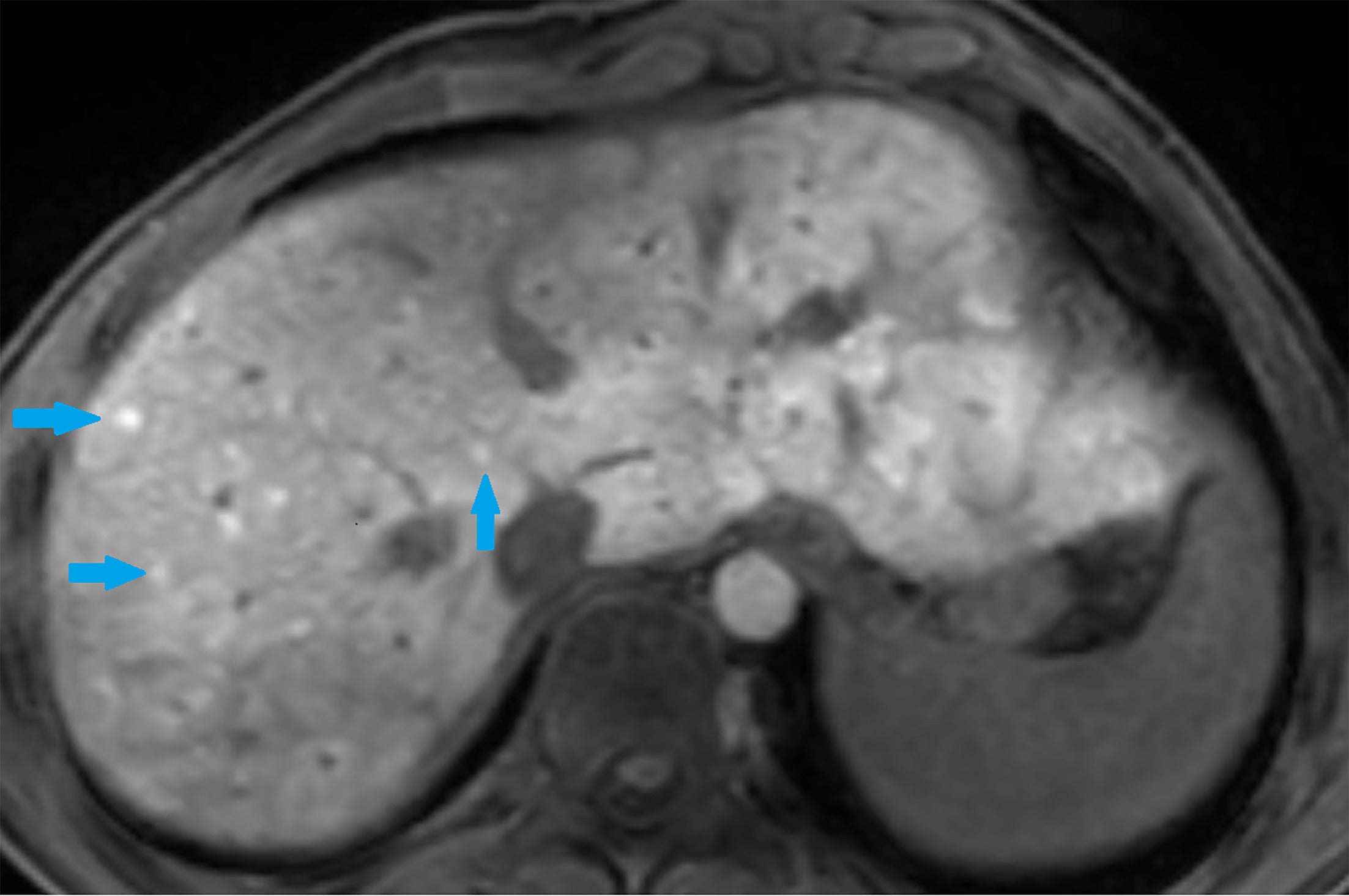 Fontan-Associated Liver Disease | Applied Radiology