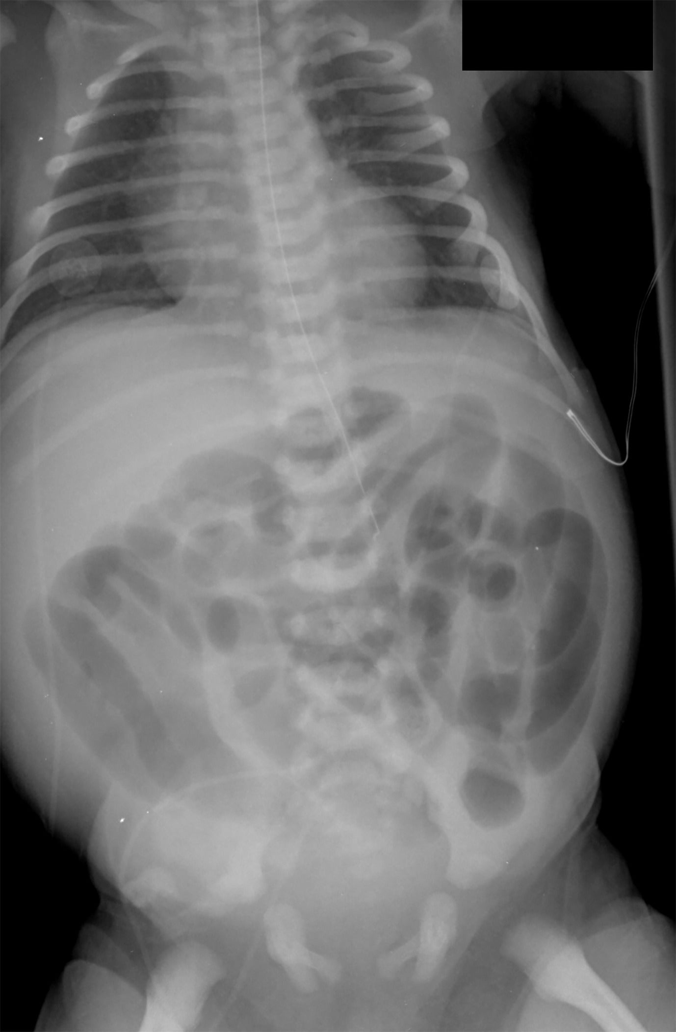 Meconium Ileus Symptoms