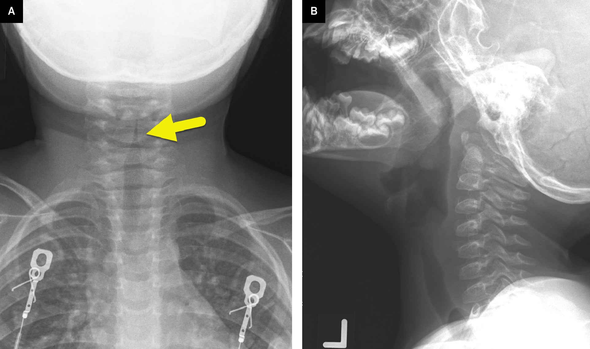 Croup | Applied Radiology