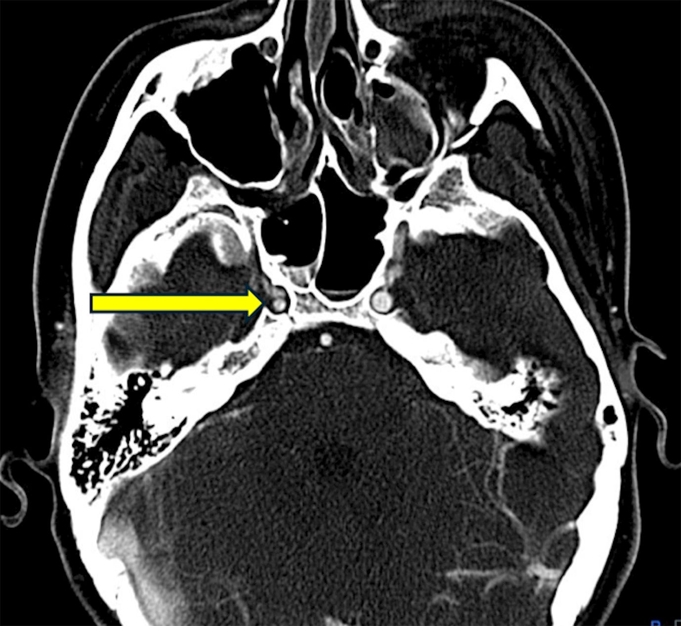 Traumatic Internal Carotid Artery Dissection | Applied Radiology