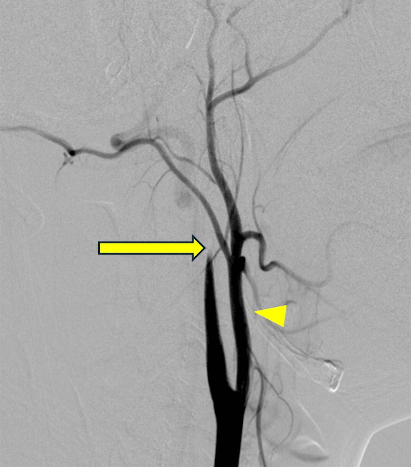 Traumatic Internal Carotid Artery Dissection | Applied Radiology