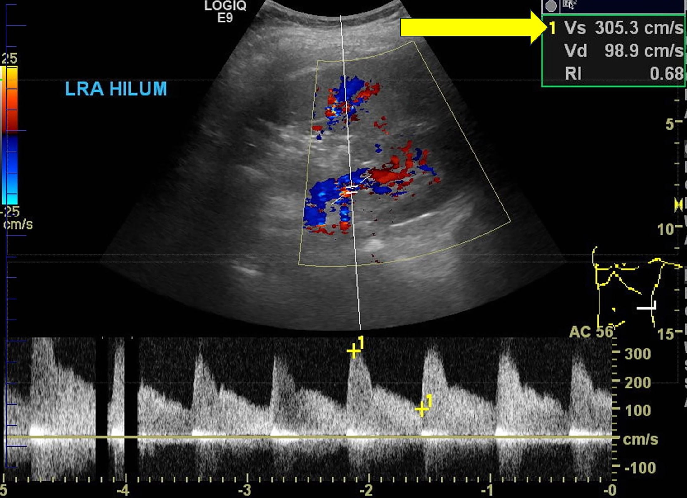 Renal Artery Fibromuscular Dysplasia | Applied Radiology
