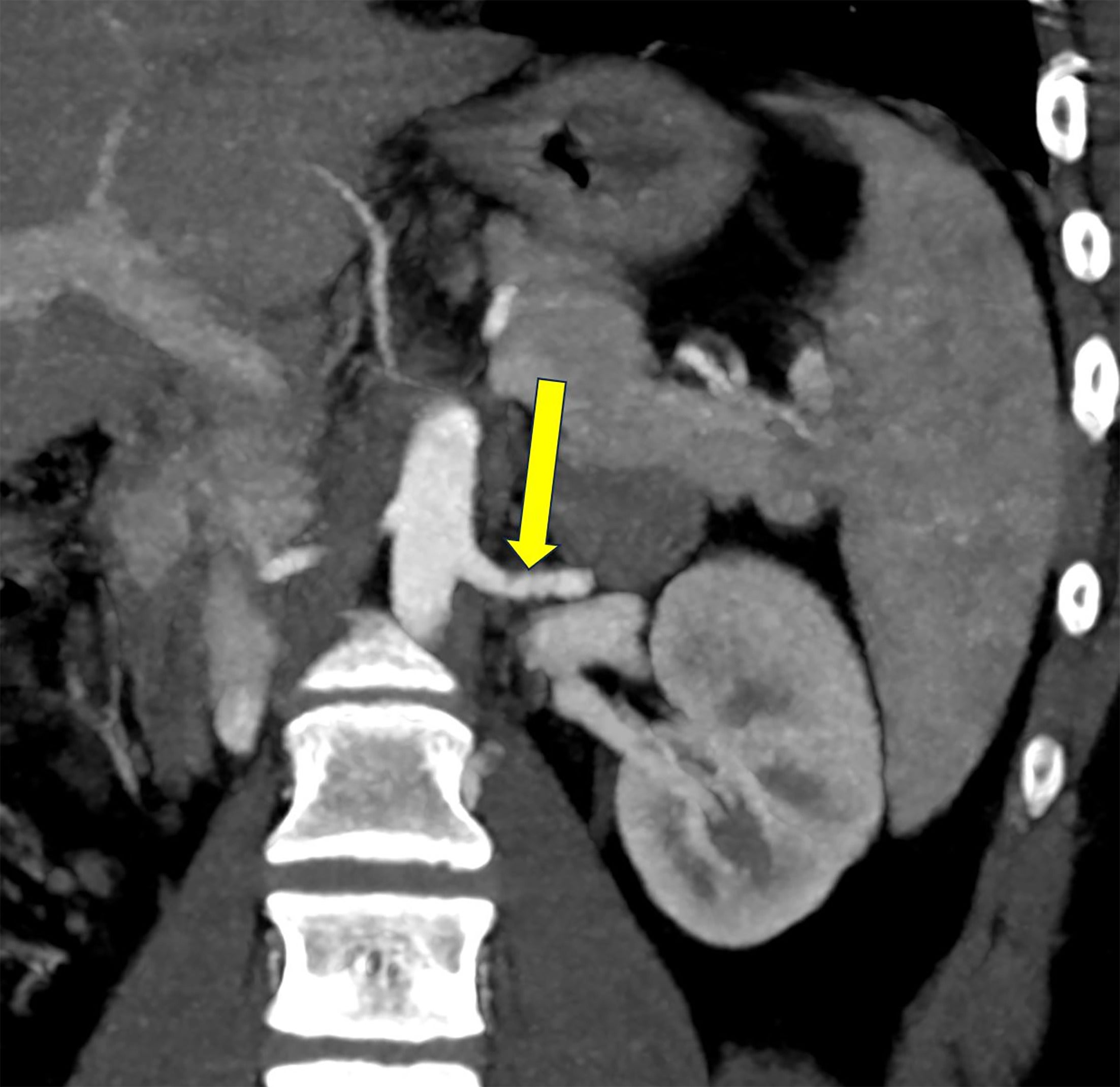 Renal Artery Fibromuscular Dysplasia | Applied Radiology
