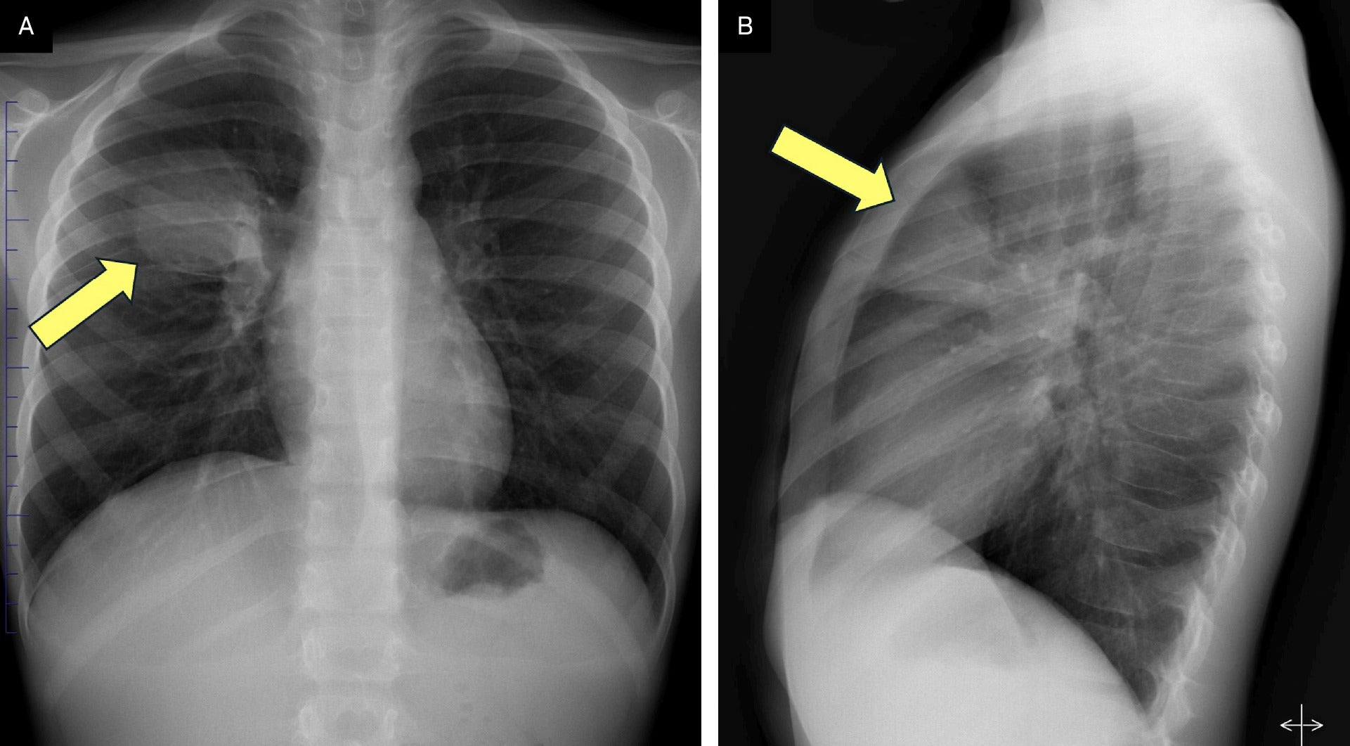 Round Pneumonia | Applied Radiology