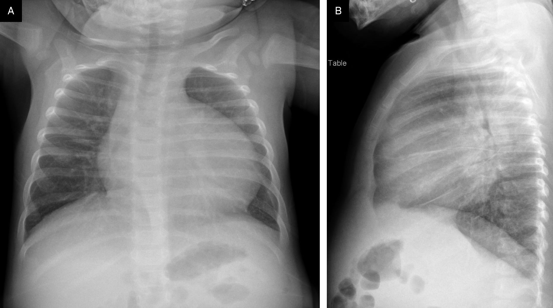 Cardiac Chloroma | Applied Radiology