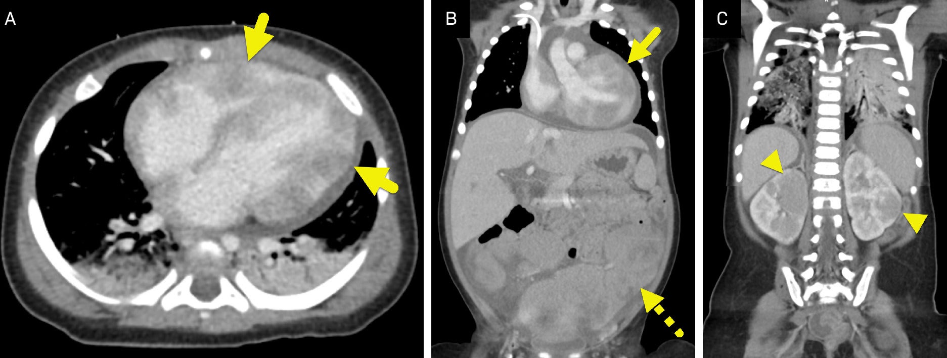 Cardiac Chloroma | Applied Radiology