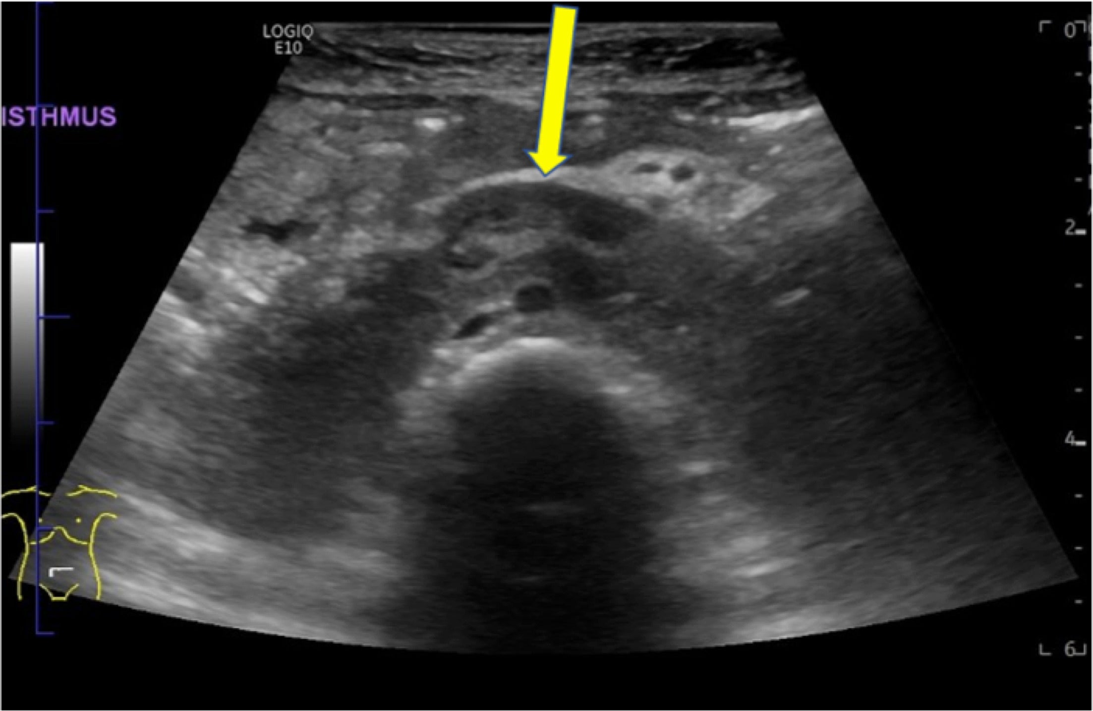 Horseshoe Kidney | Applied Radiology