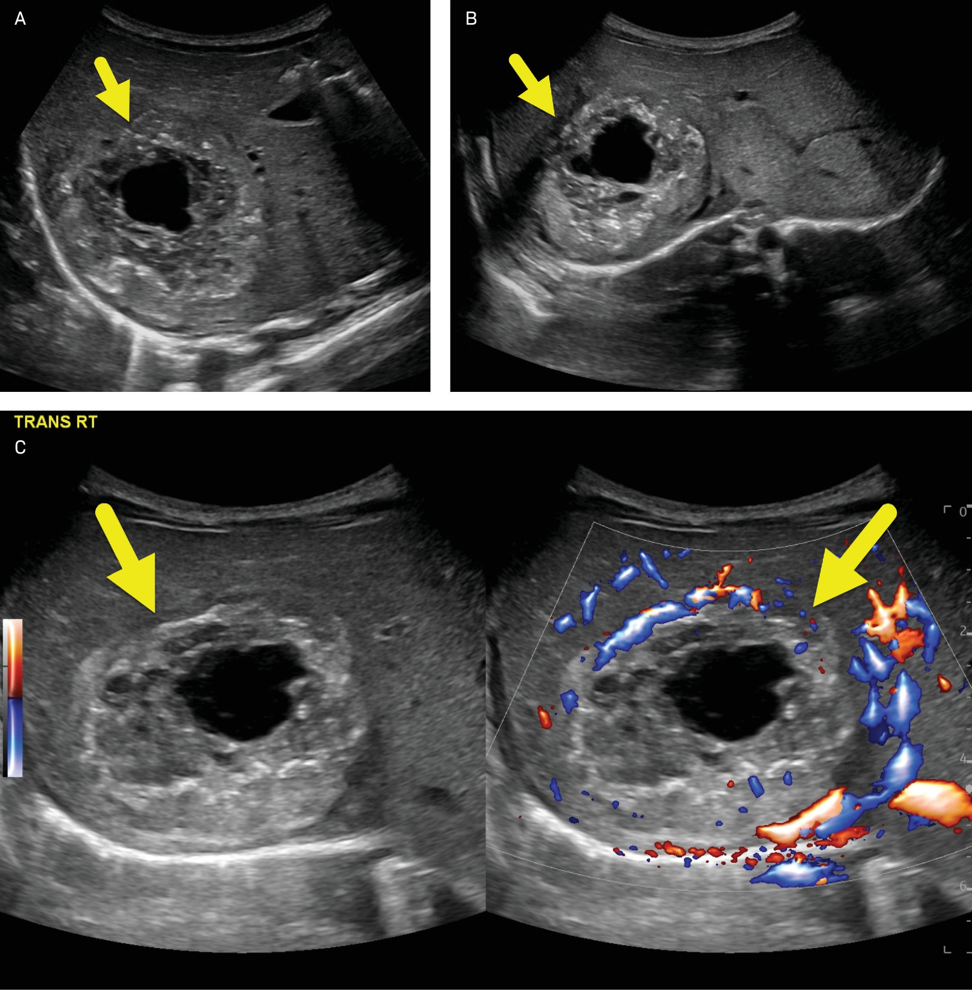 Hepatic Hemangioma | Applied Radiology