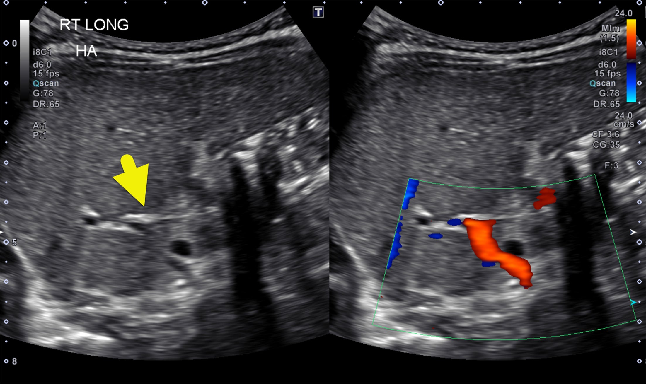 Biliary Atresia | Applied Radiology