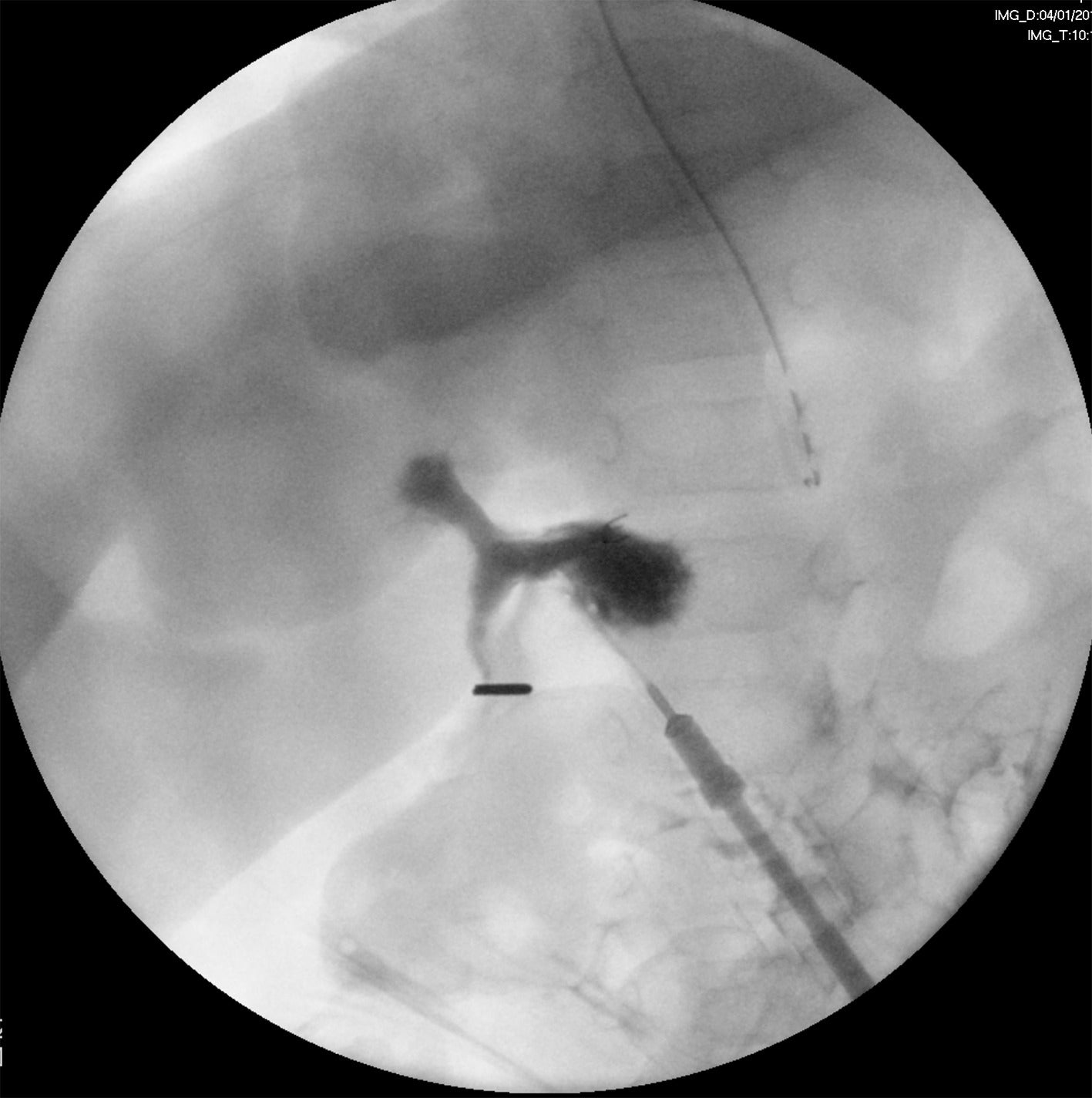 Biliary Atresia | Applied Radiology