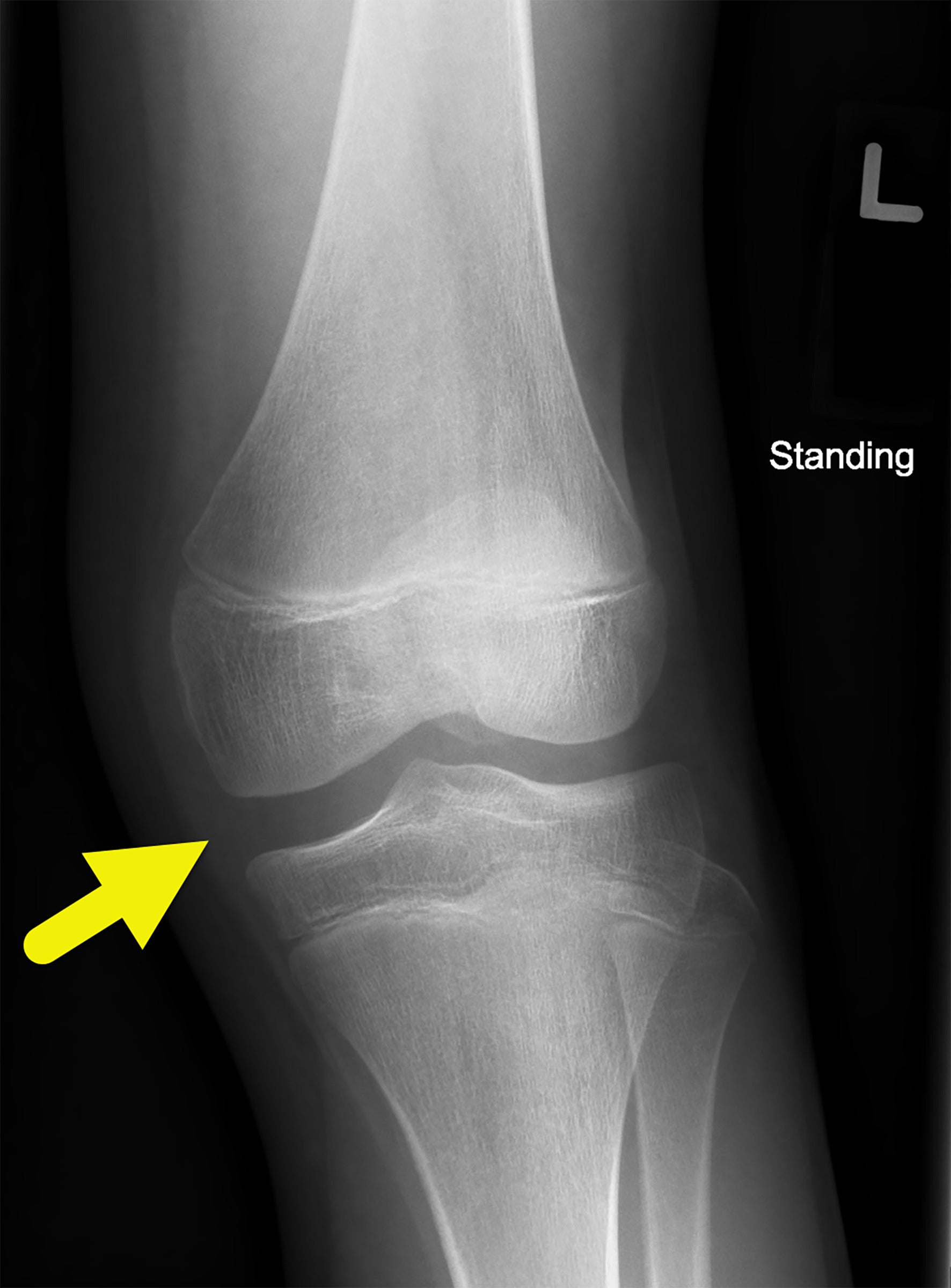Discoid Meniscus | Applied Radiology