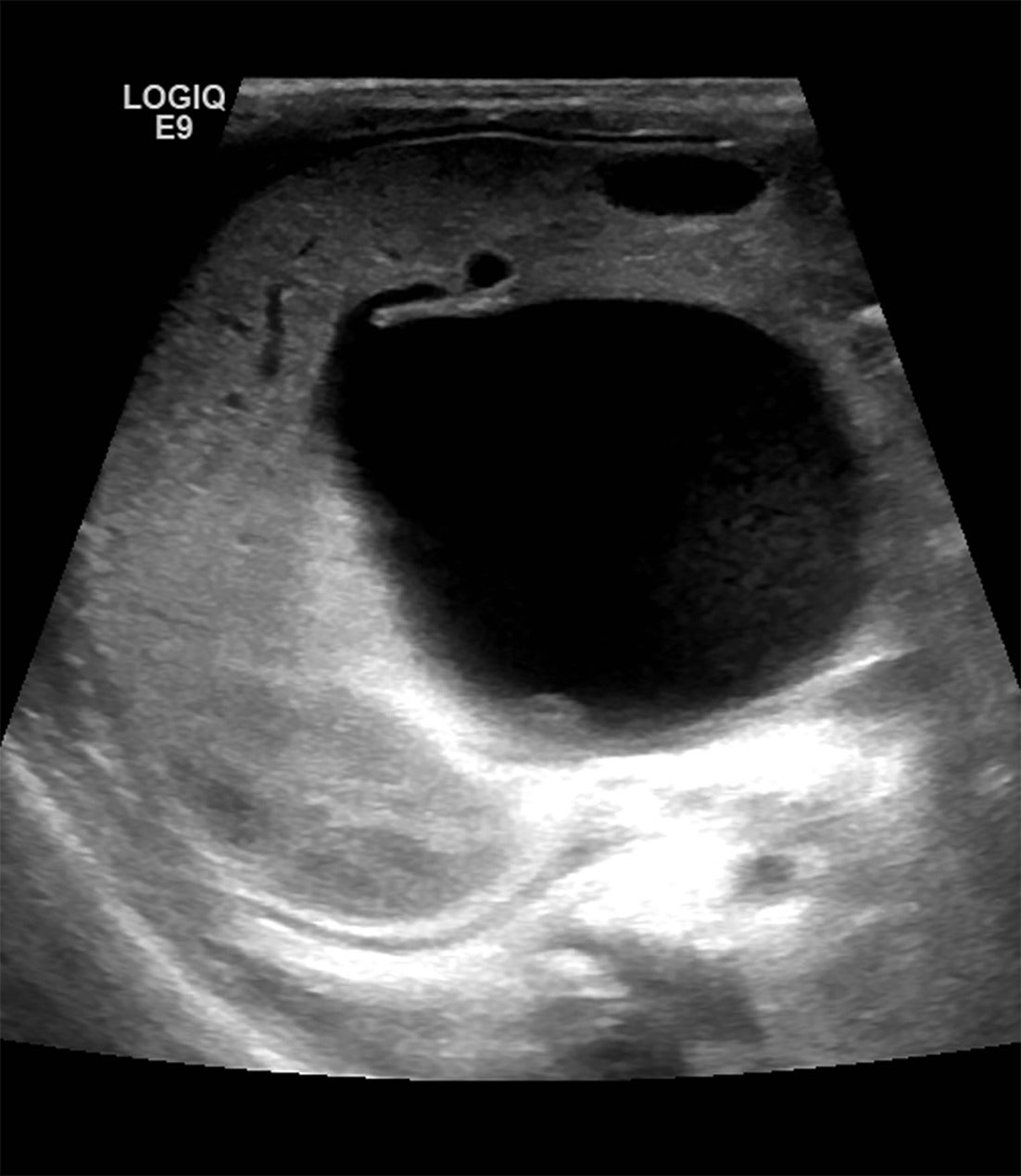 Choledochal Cyst | Applied Radiology