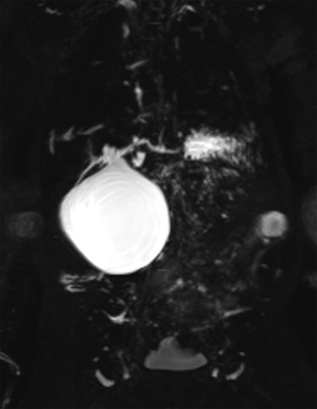 Choledochal Cyst | Applied Radiology