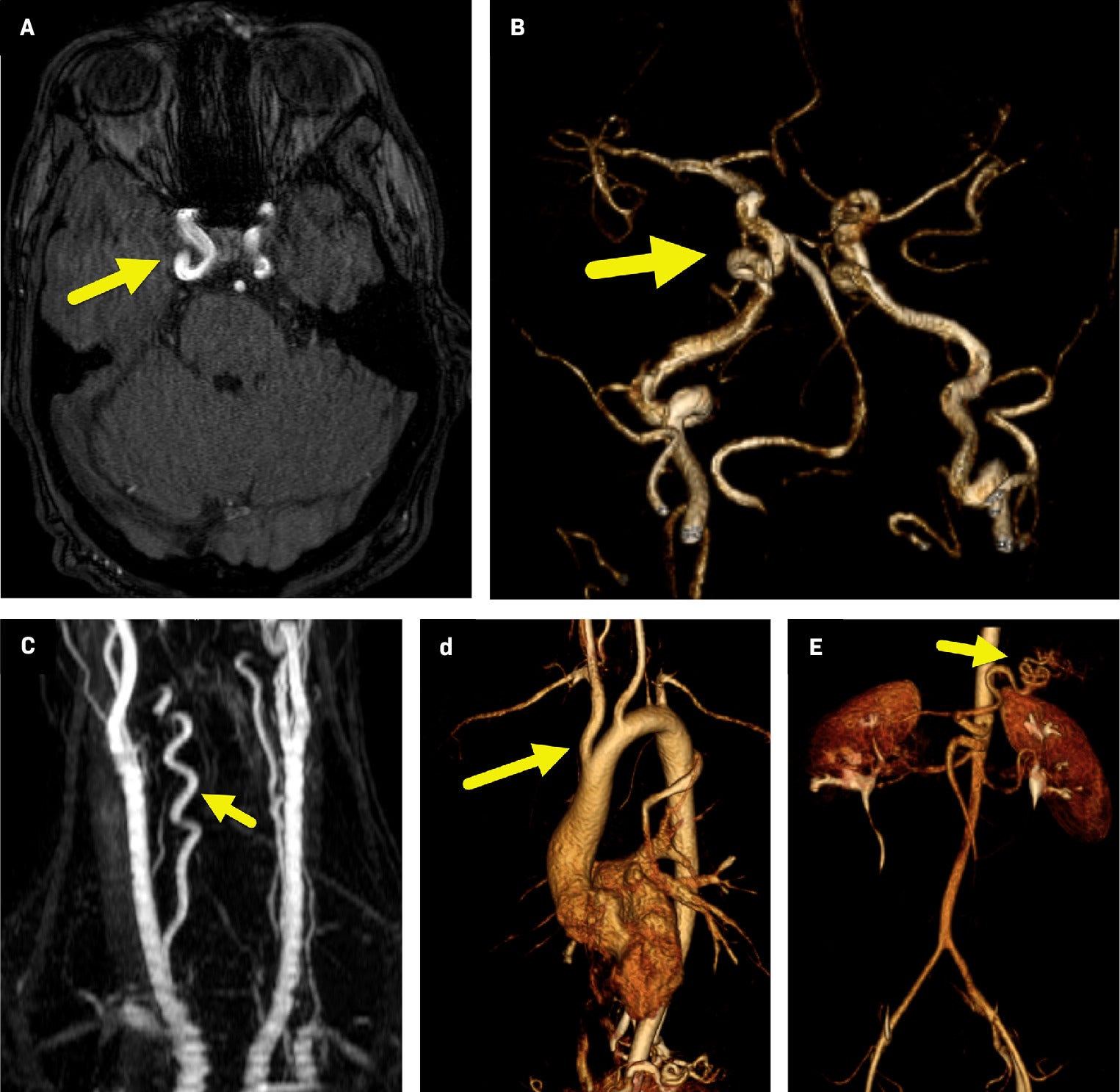 Loeys-Dietz Syndrome | Applied Radiology