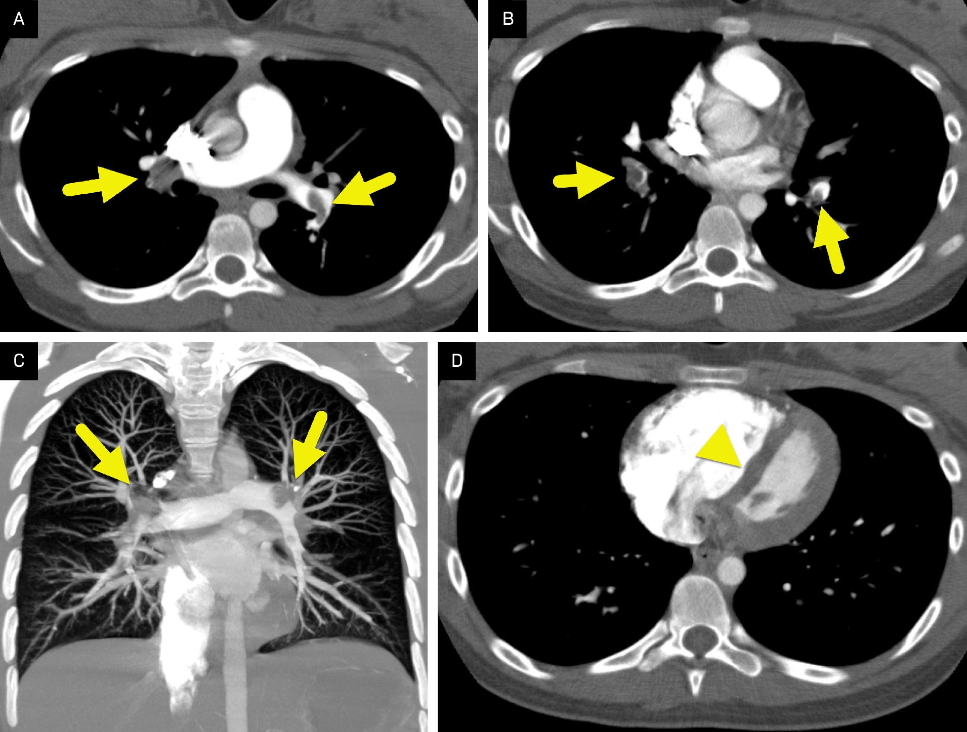 Pulmonary Embolism in Children | Applied Radiology