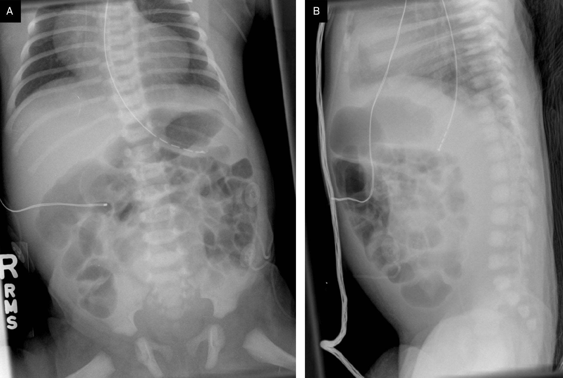 Small Left Colon Syndrome | Applied Radiology